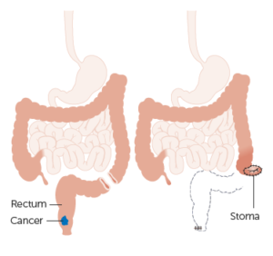 Rectal Cancer | Laparoscopic rectal cancer surgery in Chennai