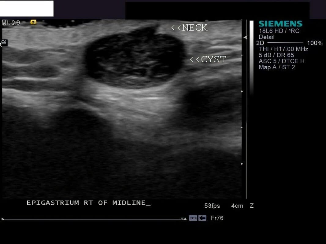 Sebaceous Cyst Surgery | Sebaceous Cyst Doctor in Chennai
