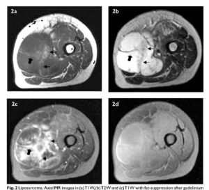 Lipoma Specialist Doctor | Best Lipoma Treatment in Chennai